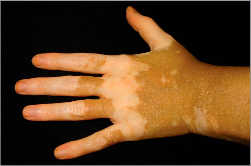 Calidad de Vida Según la Ubicación de las Lesiones del Vitiligo