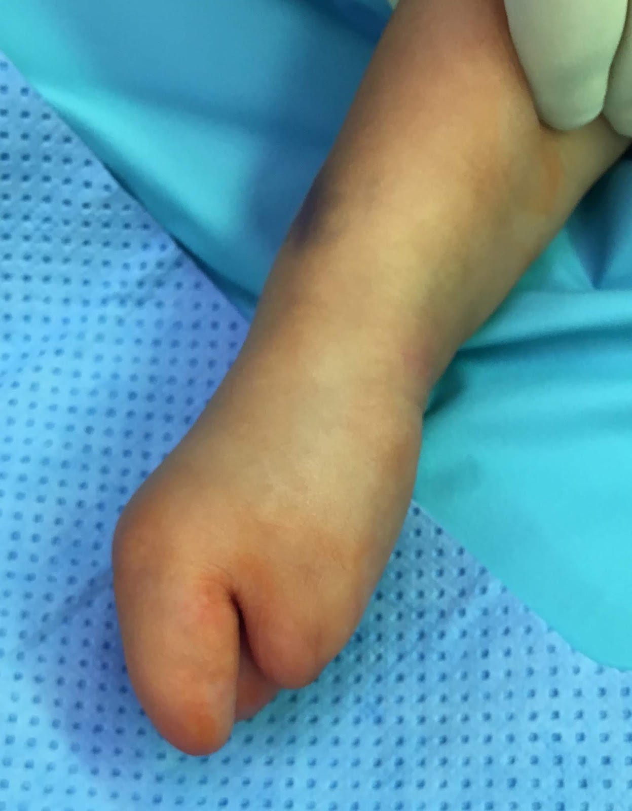 Thumb Space In Amniotic Band Congenital Hand And Arm Differences