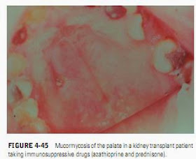 Burket’s Oral Medicine: Mucormycosis