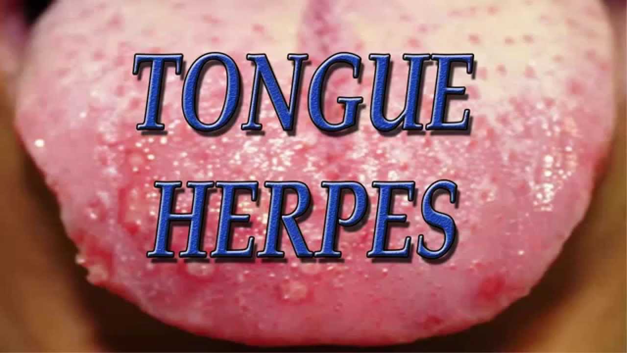 Cara Menyembuhkan Herpes Secara Alami Pengobatan Tradisional Liver cara-menyembuhkan-herpes-secara-alami-pengobatan-tradisional-liver