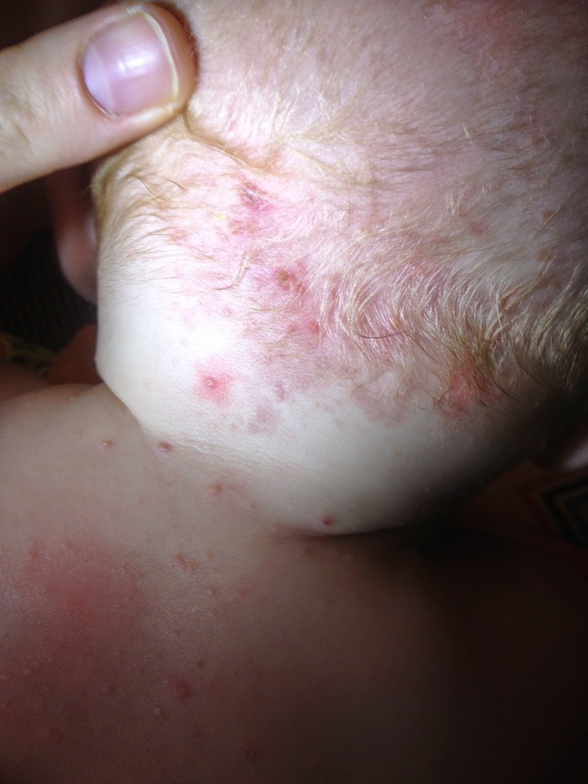 SammyAnne & Bran: Oliver and Langerhans Cell Histiocytosis