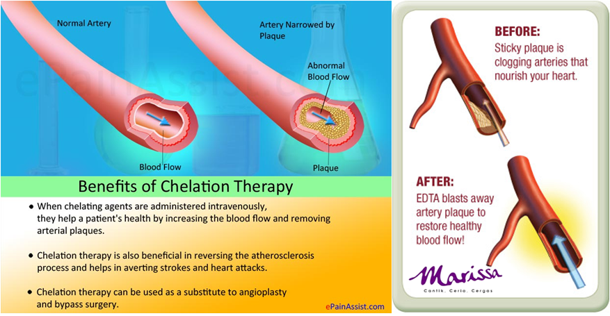 CHELATION: Chelation Therapy
