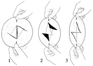 Curso de Cirugía Plástica CiruplasMedia: Colgajos