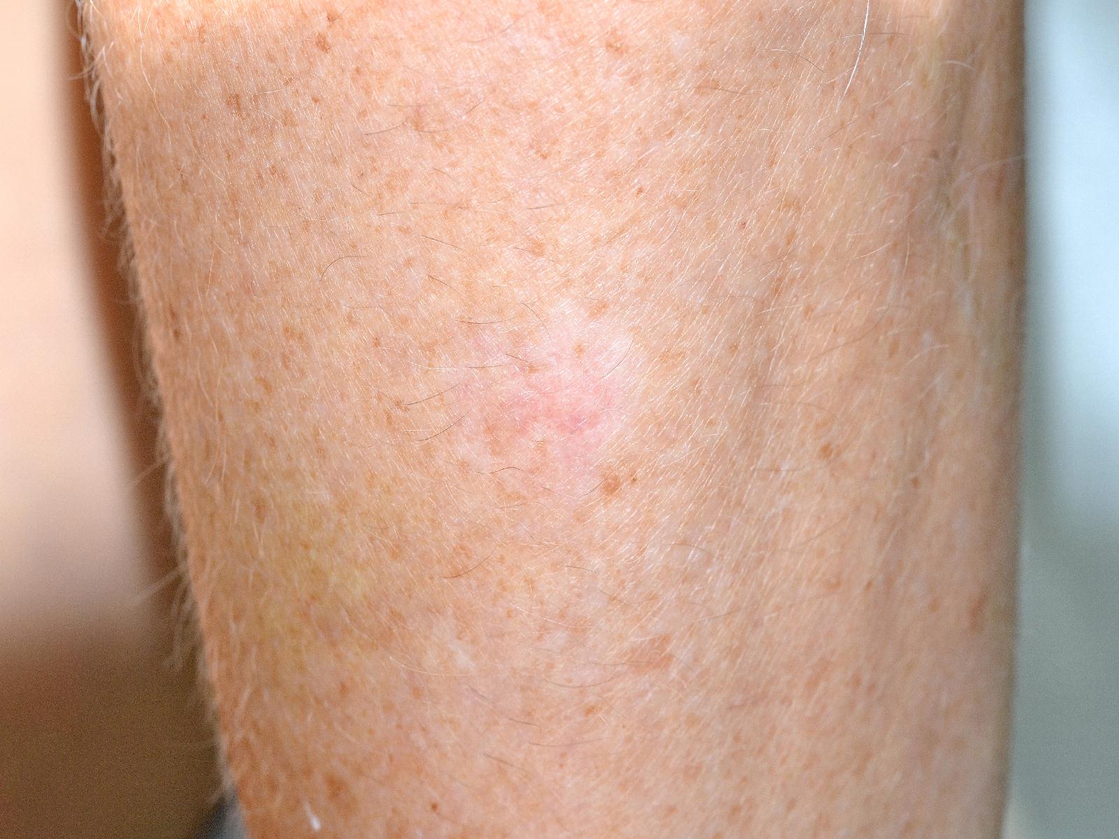 Melanoma Skin Cancer: Amelanotic Melanoma Overview