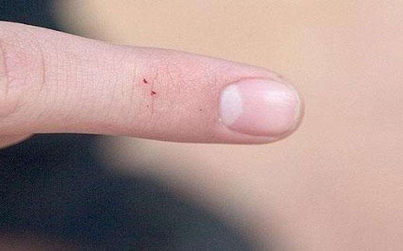 Associazione Eroi nel Quotidiano - Cesate.: PRIMO SOCCORSO - MORSI DI RAGNO