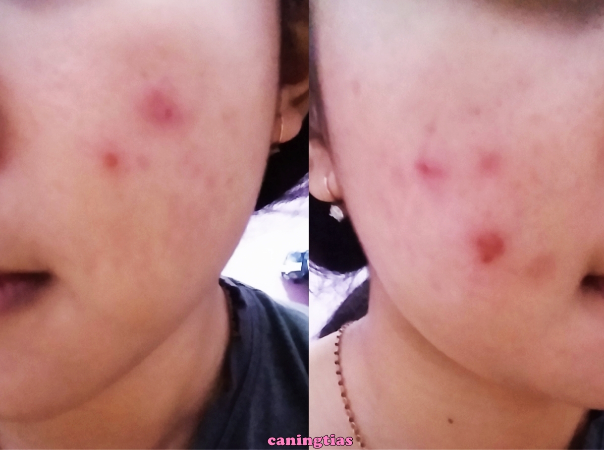 [ACNE FIGHT] Dua Bulan Melawan Jerawat dengan Tretinoin 0,05 Reticor ...
