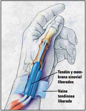 Enfermedades profesionales, un enemigo silencioso.: Tenosinovitis de ...