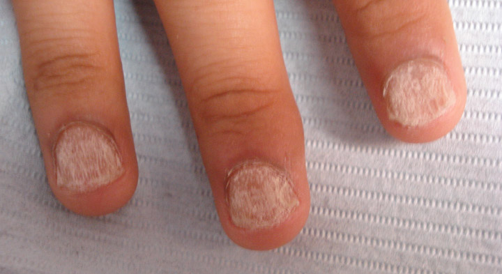 VIRTUAL GRAND ROUNDS IN DERMATOLOGY 2.0: Alopecia Areata and Twenty ...