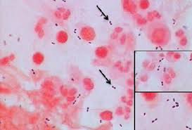 Prepare for Medical Exams : Role of Sputum Gram Stain And Culture In A ...