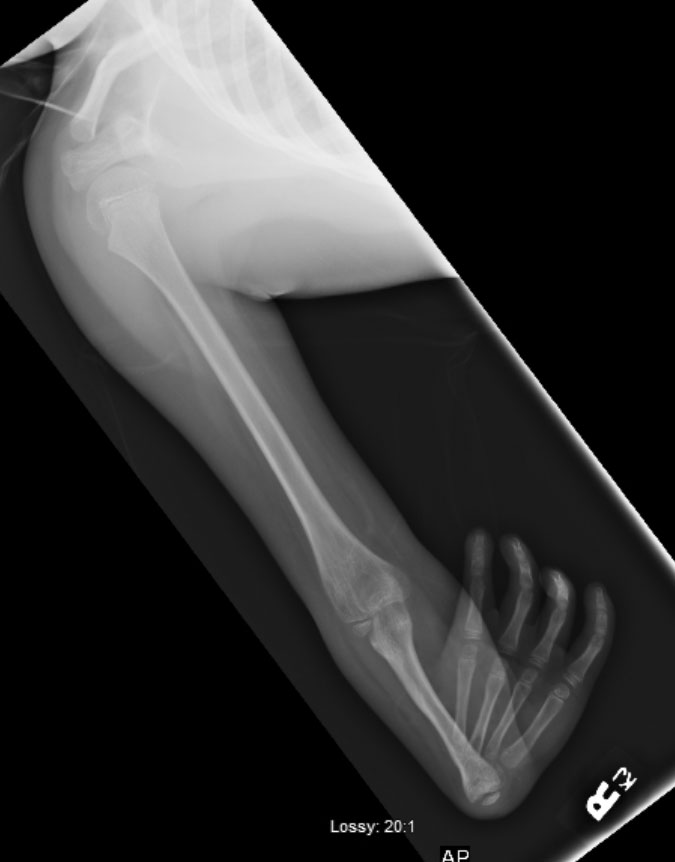 Radial Deficiency, Doing Fine | Congenital Hand and Arm Differences ...