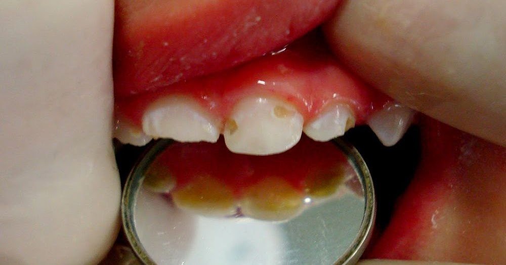 What is Early Childhood Caries ? - odontobebe