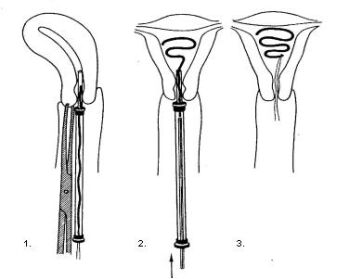 Kuliah - Q: Makalah KB IUD