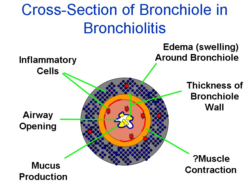 Bronchiolite