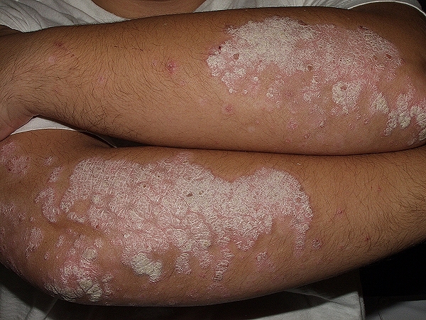 DERMATOLOGIA: PSORIASIS