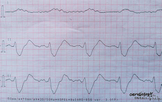 [CASE] 'Shark Fin' sign - true killer among ECG ischemic patterns