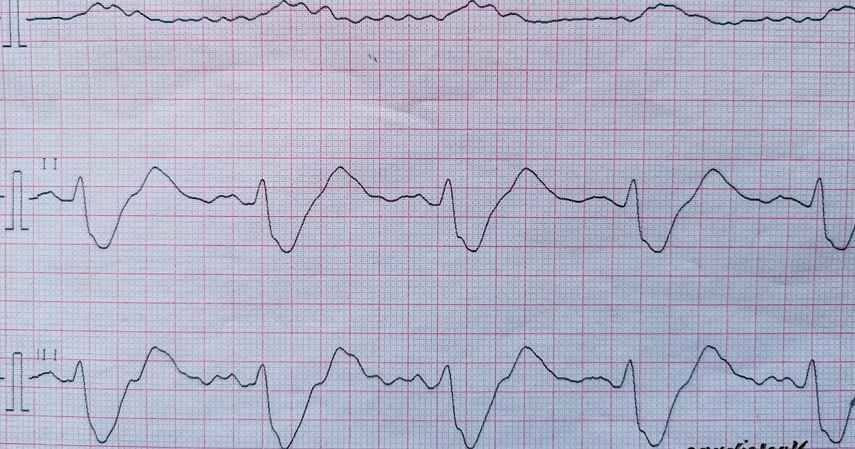 [CASE] 'Shark Fin' sign - true killer among ECG ischemic patterns