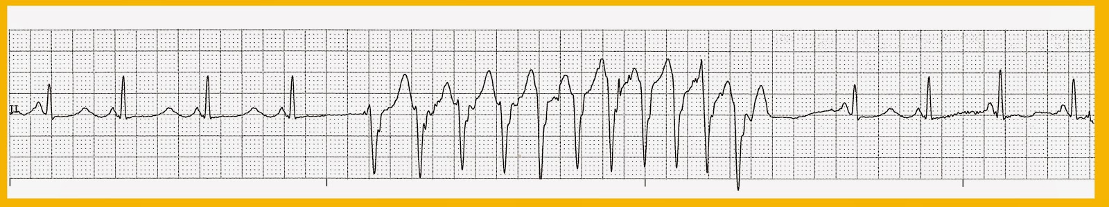 Various Ventricular Tachycardias