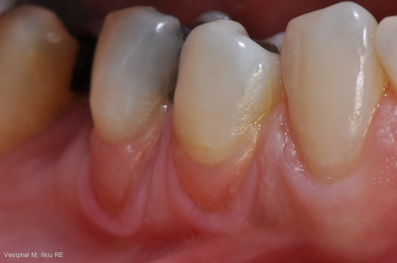 M. Vestphal - Odontologia Estética: Restauração Classe V com Resina ...