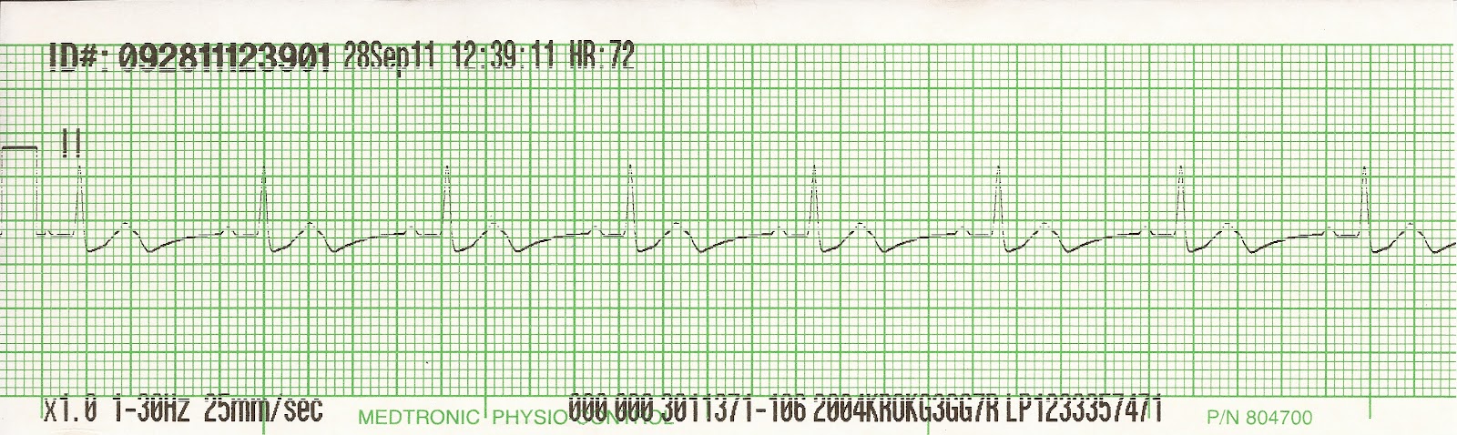Float Nurse: EKG Rhythm Strips 15: Sinus Rhythms