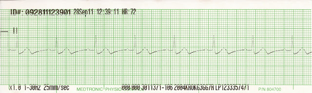 EKG Rhythm Strips 15: Sinus Rhythms