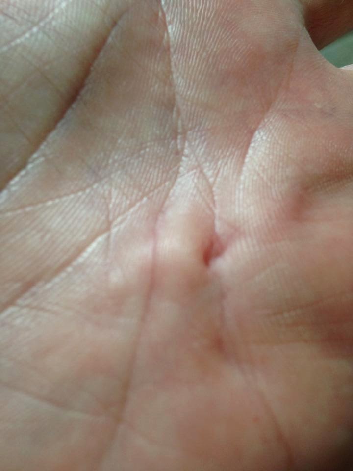 Ledderhose Disease Blog: Interview: Ledderhose surgery patient from Ohio