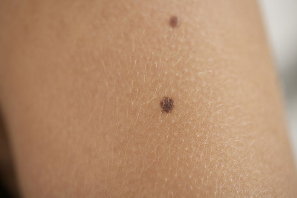 Mladez ili melanom: kako prepoznati rak koze - Acina Svaštara