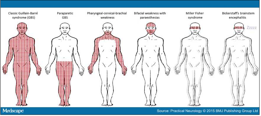 Síndrome de Guillain-Barré y Miller Fisher : grandes imitadores y un ...