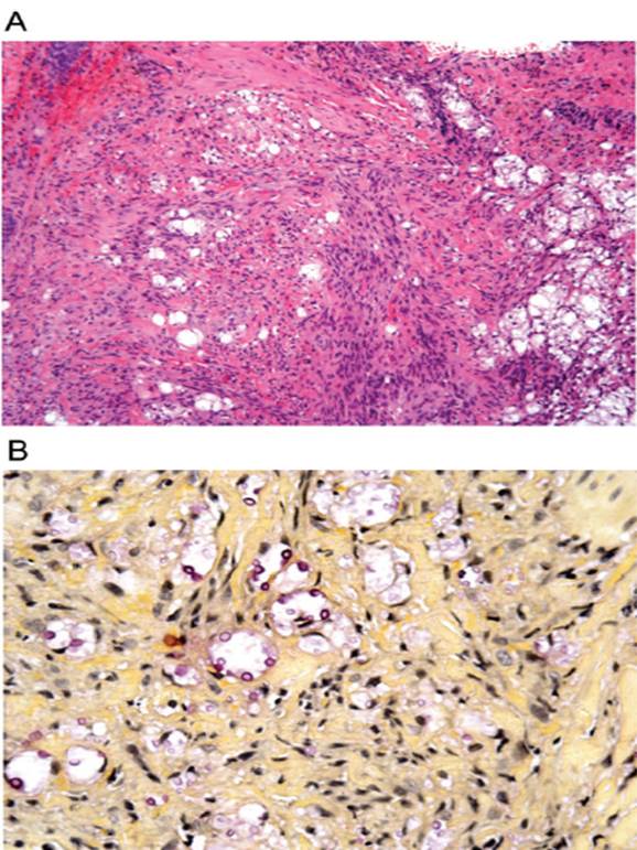 Blog del Internista: An Exophytic Mass on the Mandible of an ...