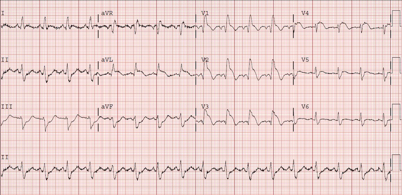 Dr. Smith's ECG Blog: ST depression, pulmonary edema, and severe ...