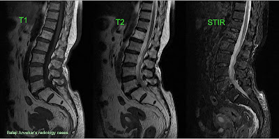 Dr Balaji Anvekar FRCR: Radiotherapy induced fatty marrow