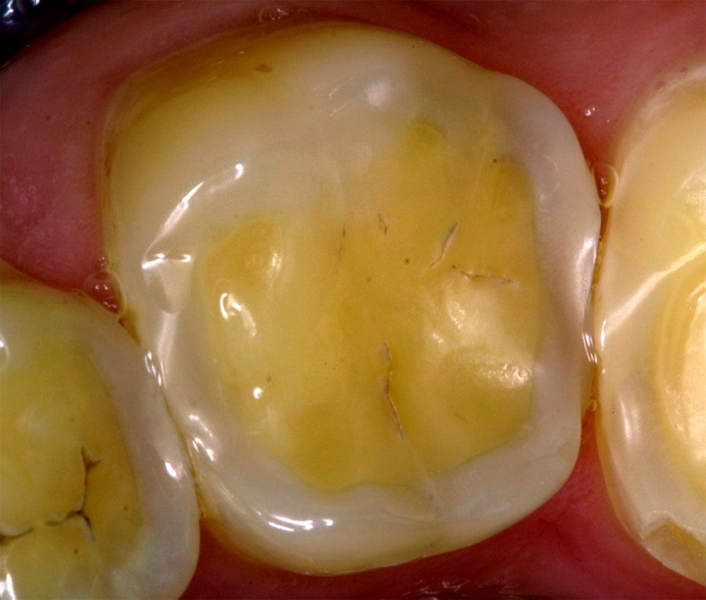 ORAL PATHOLOGY : Dental erosion in children: A literature review ...