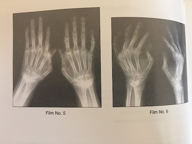 XRAYS OF RHEUMATOID ARTHRITIS