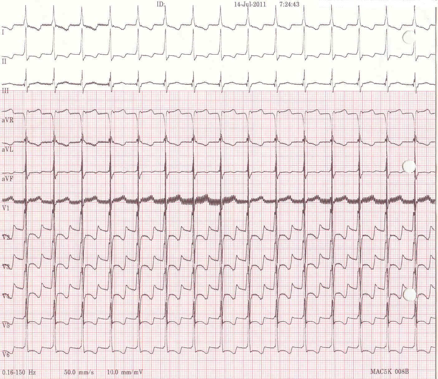 Pedi cardiology: EP, ICU: Junctional Tachycardia vs. Ventricular ...