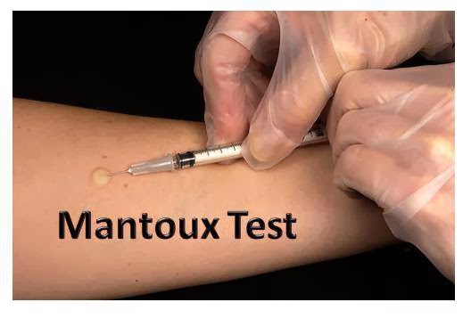 Images Of Negative Mantoux Test