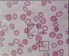 fichero hematologia: noviembre 2014