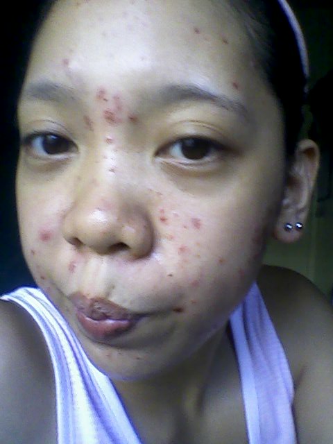 Looking Inside the Box: ACNE JOURNAL: Day 1 of Curing