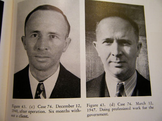 Do You Need a Lobotomy? Just Look at the Results From These Before and ...