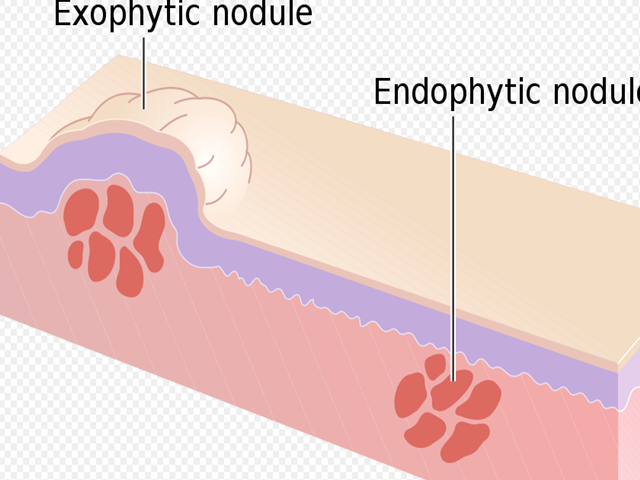 연조직 질환 용어 정리(Macule, patch 등) ~ Healthy Happy