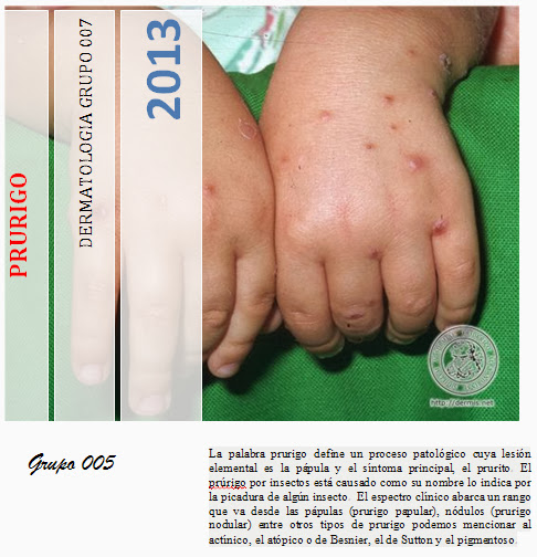 Dermatología 007: Prurigo (Grupo 5)