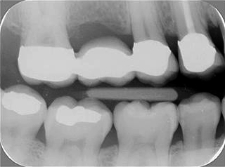 Clinica Omega: Reconstrucción con perno