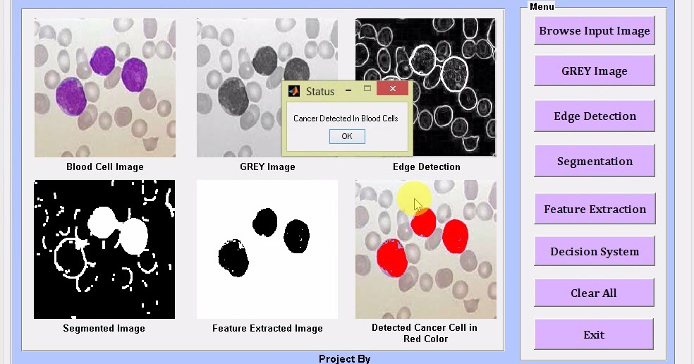 Leukemia Cancer Detection Using Image Processing Matlab Project Code