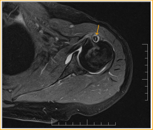 Long Head Biceps Tear-MRI - Sumer's Radiology Blog