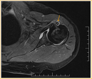 Long Head Biceps Tear-MRI - Sumer's Radiology Blog