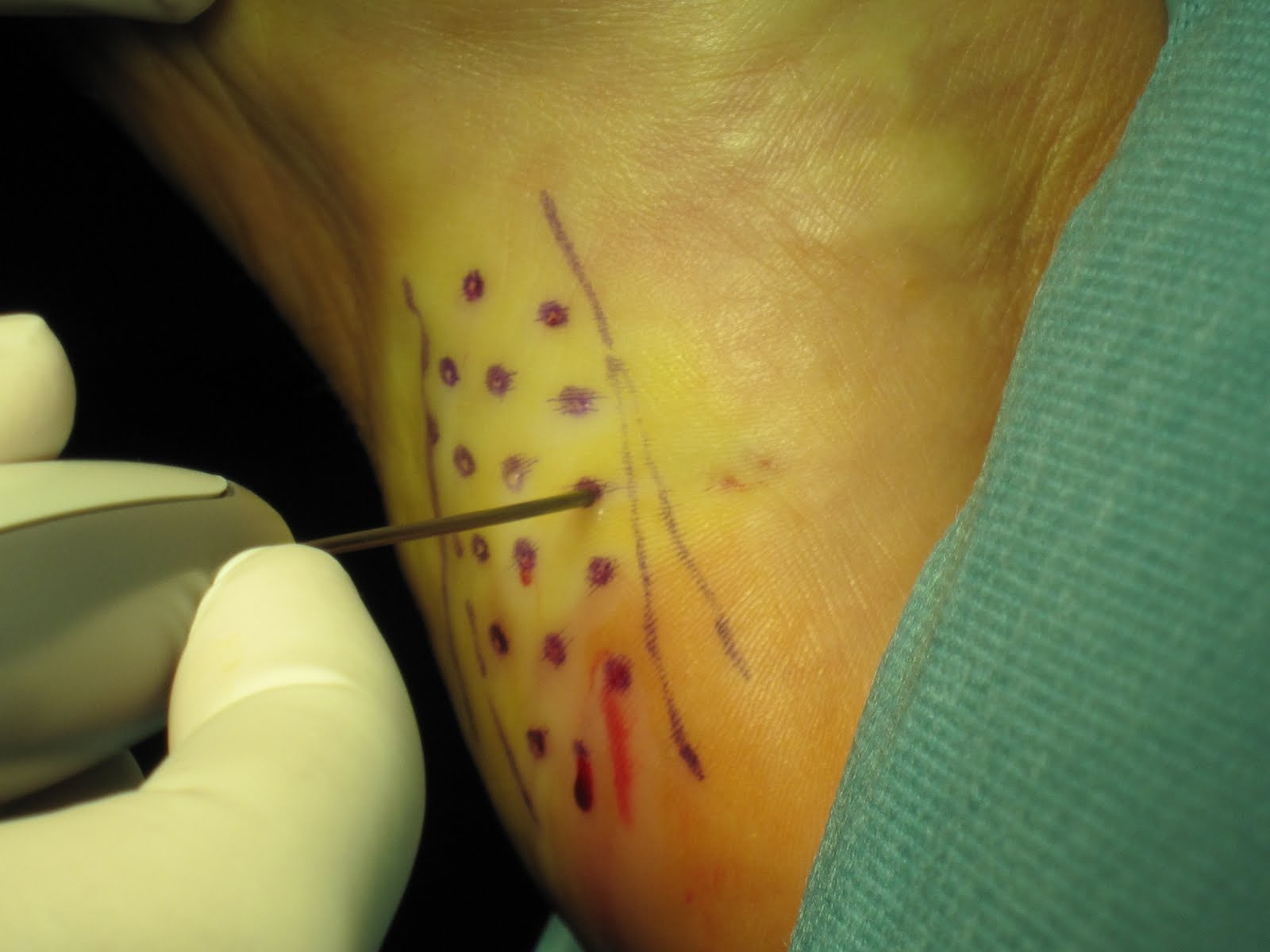 Podo Basas al Día: Fascitis plantar con TOPAZ.