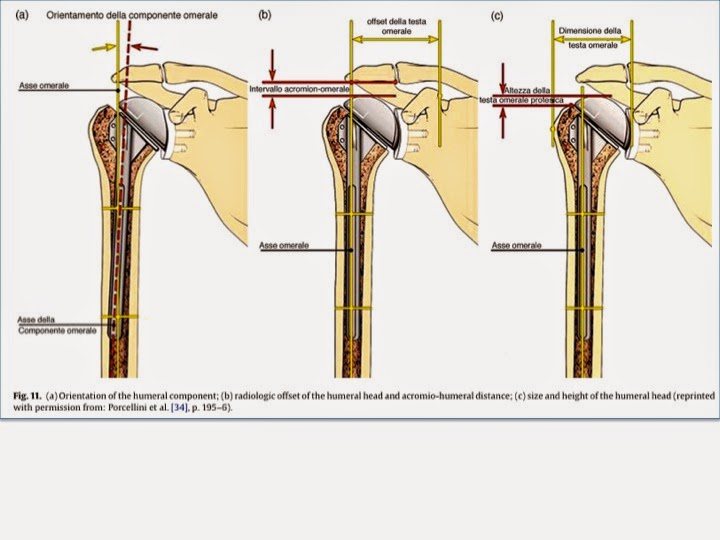 Shoulder and Elbow Surgery: The radiographic analysis of a total ...