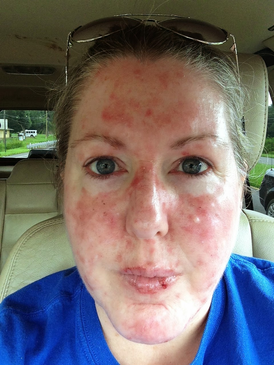 My Journey Through Topical Chemotherapy - Fluorouracil 5% Cream and ...