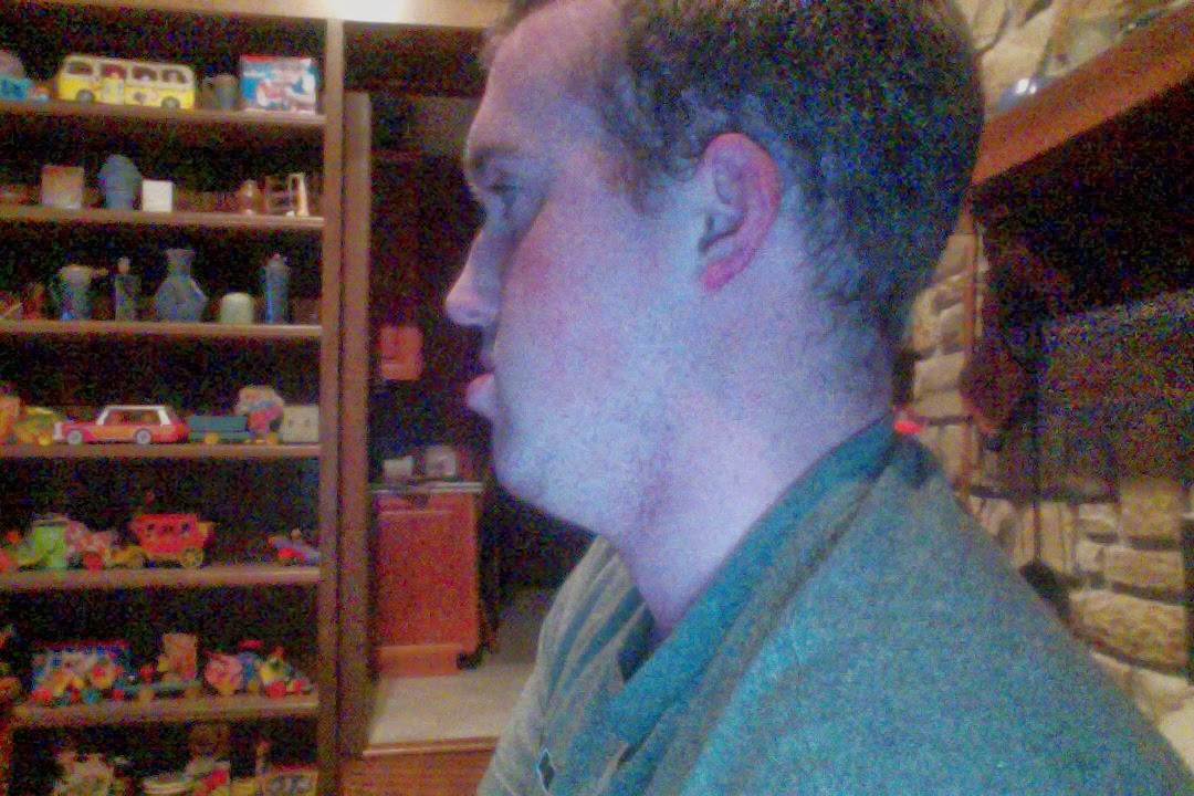 Double Jaw Surgery Lefort I Advancement Bilateral Bsso Bilateral Sagital Split Osteotomy