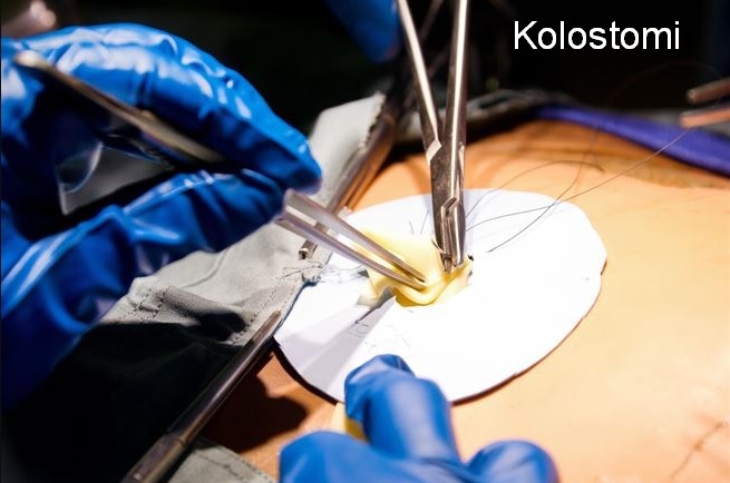 Kolostomi: Definisi, Indikasi, Jenis, dan Efeknya Bagi Pasien - Sains Ph.D