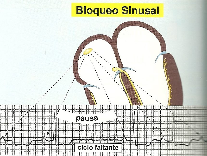 Electrocardiograma y Medicina General: Bloqueo sinusal