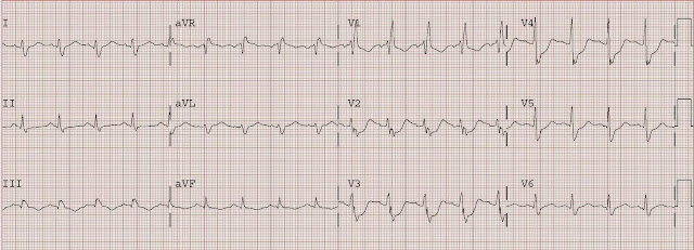 Dr. Smith's ECG Blog: Posterior ST Elevation MI in the Setting of Right ...